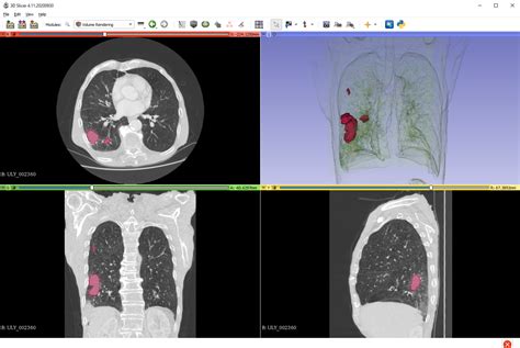 Artificial Intelligence Helps To Screen Lung Cancer More Effectively