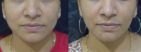 Unilateral Masseter Hypertrophy