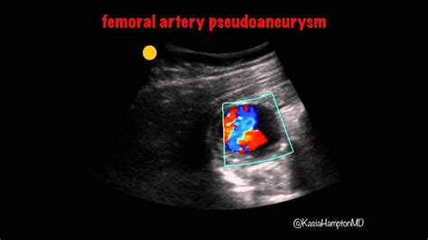 Vascular Femoral Artery Pseudoaneurysm 2 Youtube