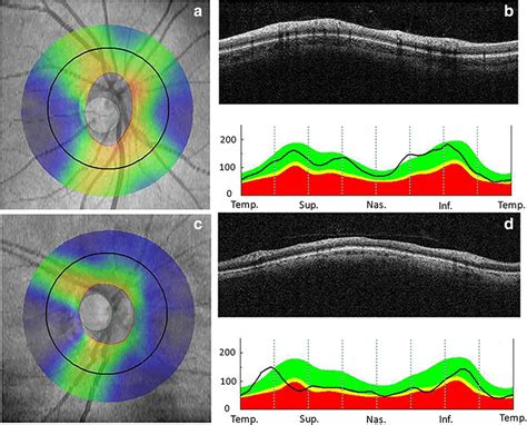 Optical Coherence Tomography Of The Optic Nerve Head And Retinal Nerve