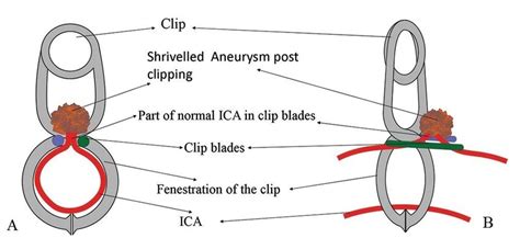 Diagram Of The Proposed New Clip During The Clipping Showing A An Download Scientific Diagram