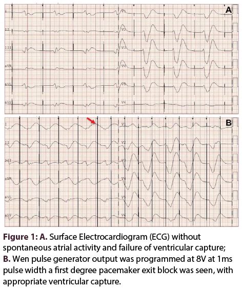 Failure Of Ventricular Capture And Pacemaker Exit Block Secondary