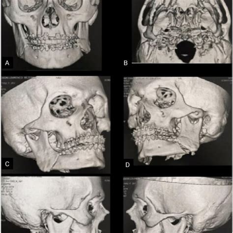Tomography Of A Patient In 3d Reconstruction In A Frontal View B Download Scientific