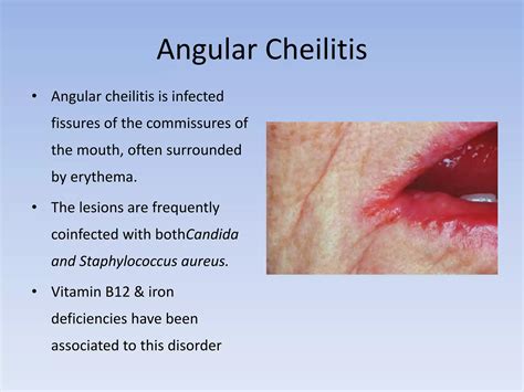 1 Fungal Diseases Of Oral Cavitypptx
