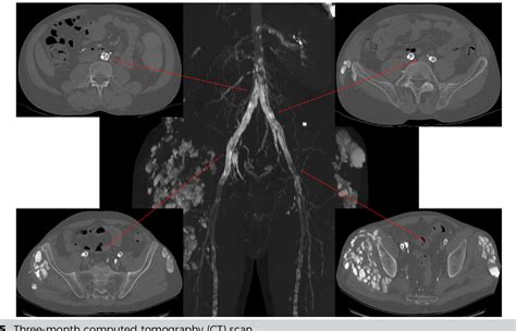 Kissing Intravascular Lithotripsy In Iliac In Stent Restenosis Related