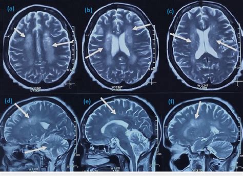 T 2 Weighted Mri Of The Brain Showing Hyperintense Signals Download Scientific Diagram