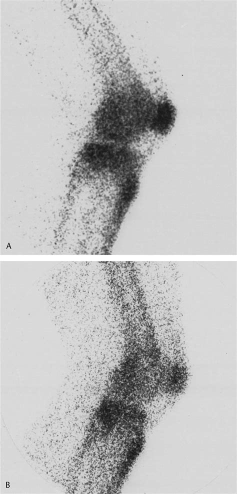 A B A A Technetium Bone Scan Of A 28 Year Old Man With Anterior Knee Download Scientific