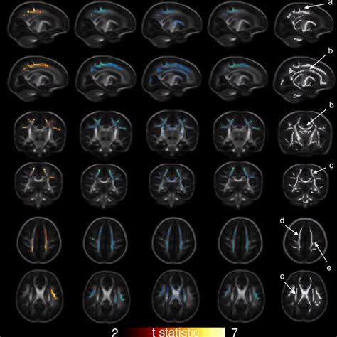 Association Of Gestational Age At Birth With Brain Volume T Statistic Download Scientific