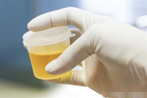 男人晨起后的“第一泡尿”，若没有这3个表现，肾脏或许还很强壮尿液