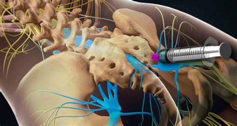 Сколько стоит сделать блокаду поясничного отдела