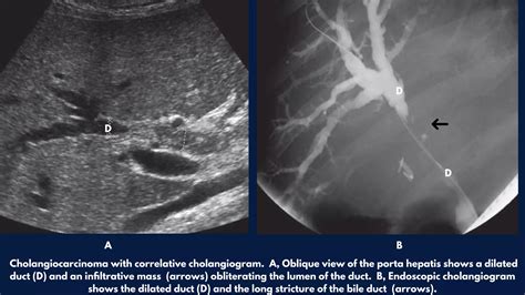 Biliary Tract Tumours Cholangiocarcinoma Cystadenoma Cystadenocarcinoma