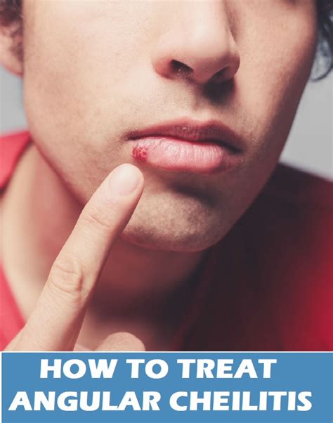 How To Get Rid Of Angular Cheilitis With Home Remedies 7 Methods