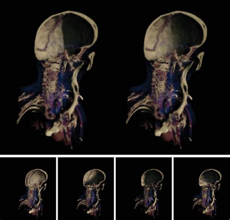 Figure 4 From Immersive 3d Medical Visualization In Virtual Reality Using Stereoscopic