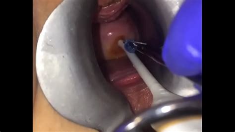 Extreme Cervix Penetration And Gyno Play XXXshake Com Video