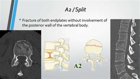 Thoracolumbar Fractures Classification Pptx