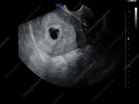 5 Week Old Embryo Transvaginal Ultrasound Scan Stock Video Clip