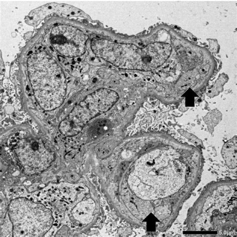 Electron Microscopy Showing Endothelial Cell Swelling With Expansion Of