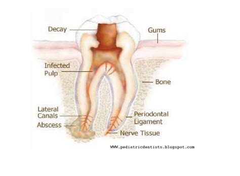 Common Dental Problem And Solution Abscessed Teeth