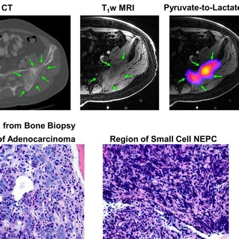 A Patient 1 75 Years Old Was Diagnosed With Metastatic Download Scientific Diagram