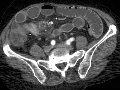 Terminal Ileum Ultralyd Abdominal Ct Small Intestine • Litfl
