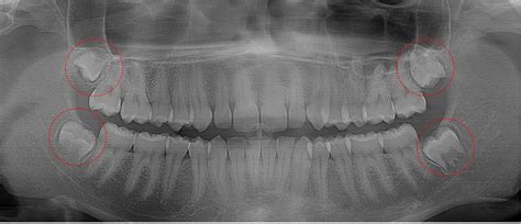 Wisdom Teeth Development Triagenics Inc