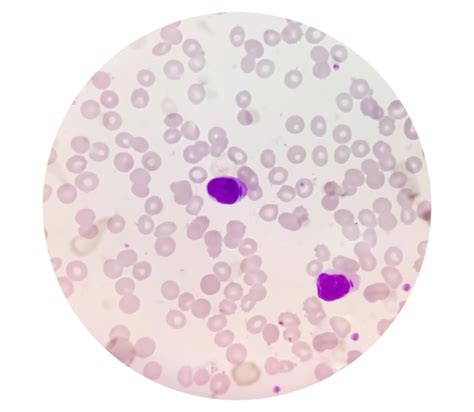 Premium Photo Myeloblast With Auer Rods Seen In Acute Myeloid Leukemia