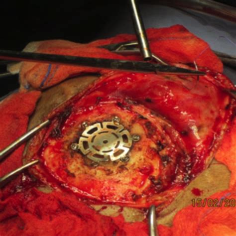 Intraoperative Photograph Showing The Skull Defect Covered With A Download Scientific Diagram