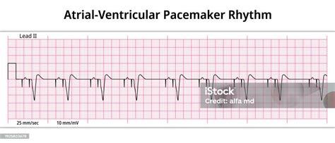Ekg Atrial Ventricular Pacemaker Rhythm Ruang Ganda Kertas Ekg 8 Detik