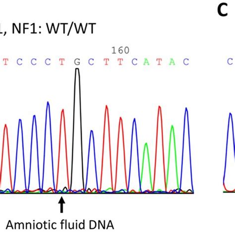 Electropherogram Profile For Sanger Sequencing In The Fetus Iv11 A Download Scientific