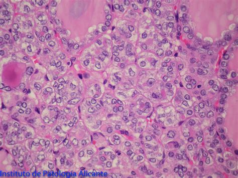 Cáncer De Tiroides Anatomía Patológica Biopsia Y Paaf