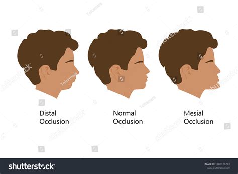 Guy Distal Normal Mesial Bite Profile Stock Vector Royalty Free 1785126743 Shutterstock