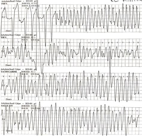 Figure 4 From Sustained Ventricular Arrhythmia And Sinus Node