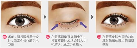 上海卧蚕手术 韩式卧蚕成型术 卧蚕和眼袋的区别 上海美莱整形医院