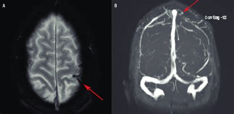 Gradient Recalled Echo Gre Sequences A With An Absence Signal Red Download Scientific