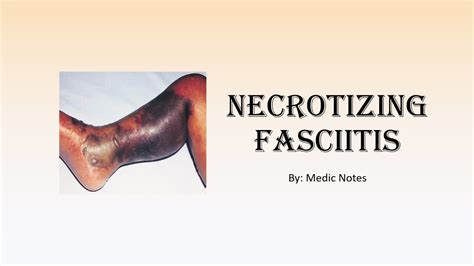 Necrotizing Fasciitis Definition