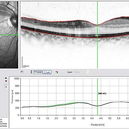 OCT Showing Increased Retinal Thickness Mainly In The Inner Retina Download Scientific