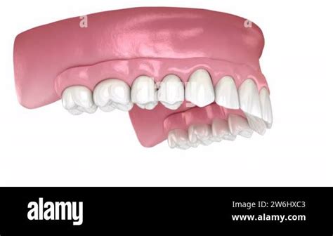 Maxillary Prosthesis All On 4 System Supported By Implants Medically