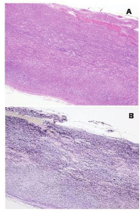 Post Mortem Aortic Specimen Obtained From A Patient Who Died From