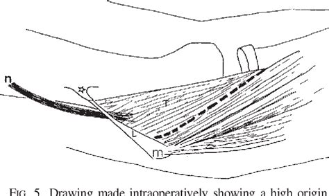 Figure 5 From Bilateral Median Nerve Compression At The Level Of