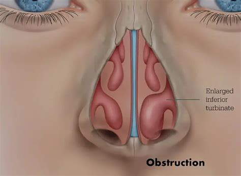 Turbinate Reduction Lowcost Surgicals