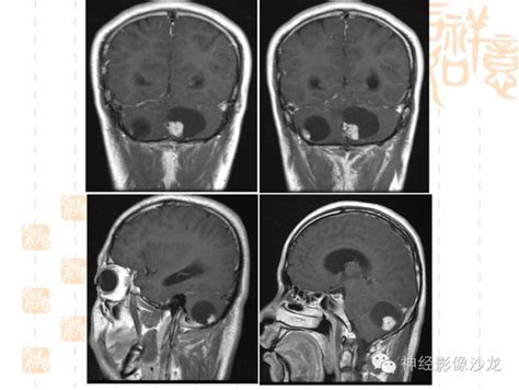 【病例】von Hippel Lindau病1例ct及mr影像表现 影像ppt