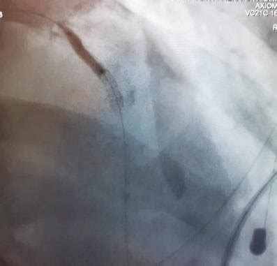 A LAD Stent Thrombosis B Plain Old Balloon Angioplasty In LAD Download Scientific Diagram