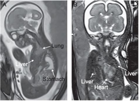 Congenital Diaphragmatic Hernia Ppt Chapter 24 Powerpoint