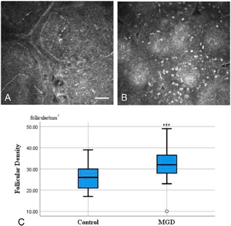 Lymphoid Follicles In Calt The Follicular Germinal Center Is Download Scientific Diagram