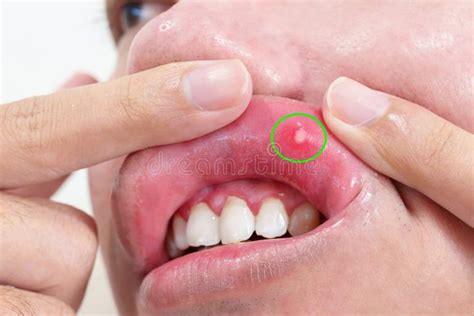Mouth Ulcer Sore Or Aphthous Stomatitis Oral Health And Medical Concepts Stock Image Image Of
