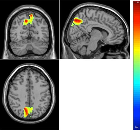 Results Of One Way Anova Showing Abnormalities In Download