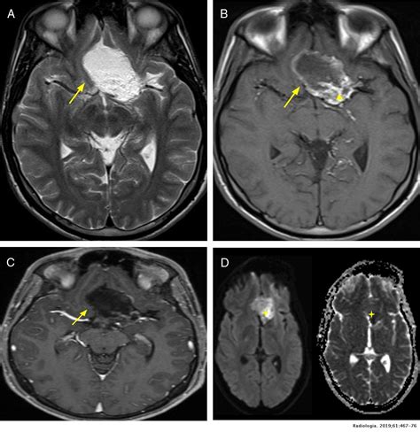 Región Selar Evaluación Mediante Resonancia Magnética De Lesiones