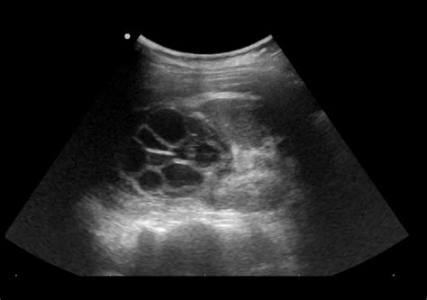 Transabdominal Ultrasound Findings Showing A Large Complex Cystic Mass