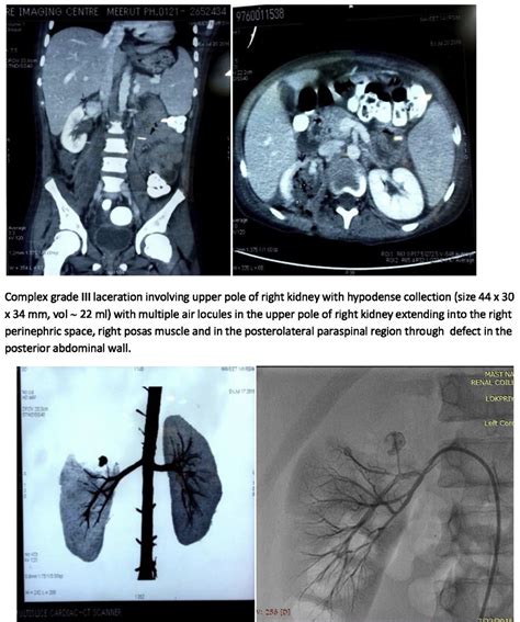 Coil Embolization Of Renal Artery Pseudoaneurysm At Erin Ayers Blog