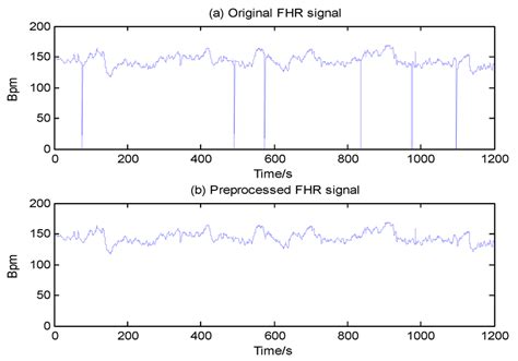 Signal Preprocessing Of No 1001 Fetal Heart Rate Fhr Recording